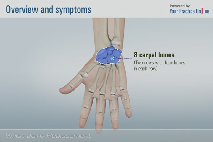 Wrist Joint Replacement | Hand & Wrist Orthopaedics Videos | Your ...