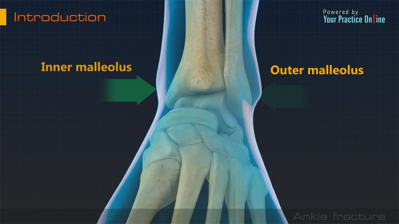 Ankle Fracture Surgery Video | Ankle Sprain | YPO Education