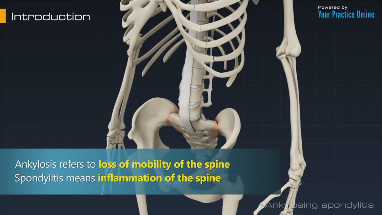 Spondylitis Treatment Video | Ankylosing Spondylitis | Spinal Surgery Spondylitis Treatment Video | Ankylosing Spondylitis | Spinal Surgery