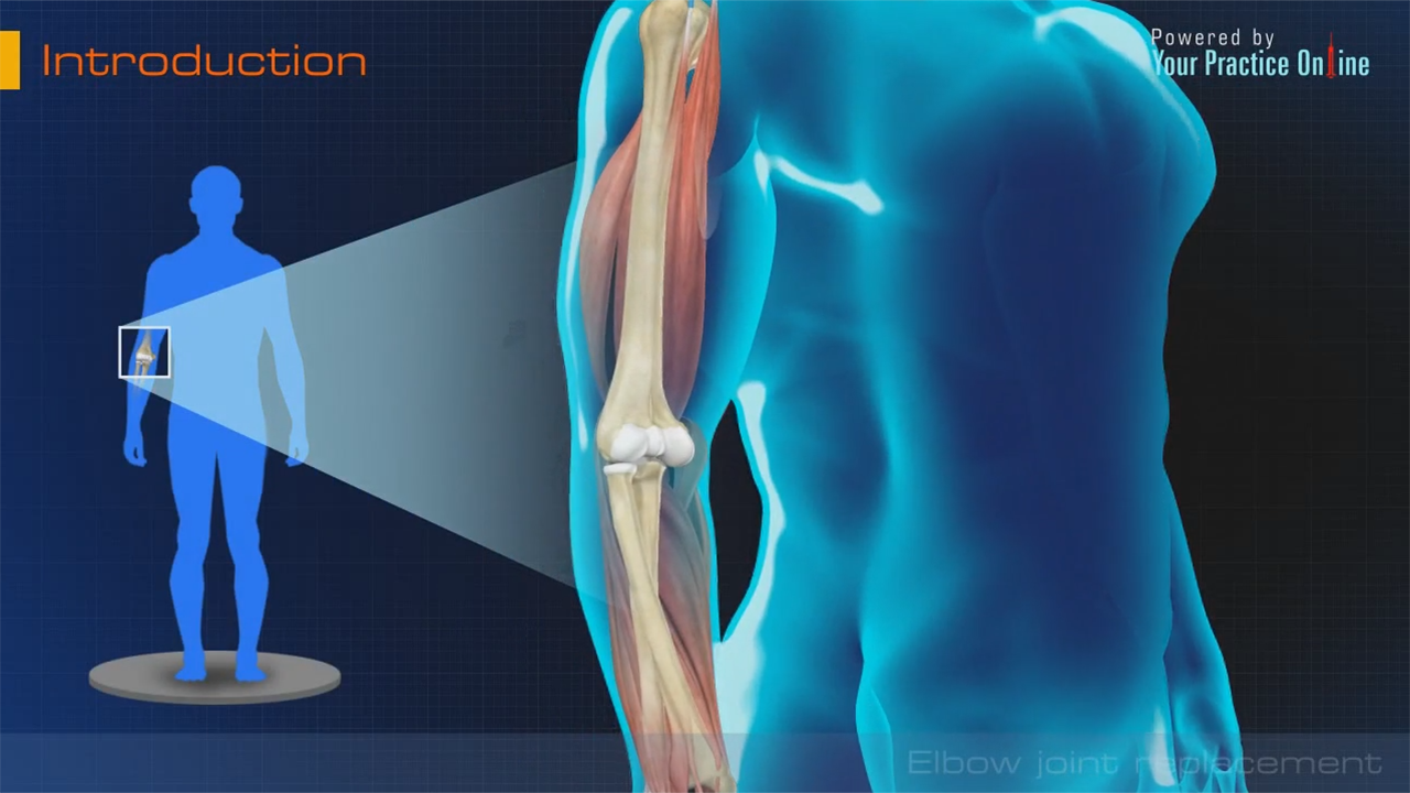 Elbow Joint Replacement Video Medical Video Library elbow-joint-replacement-video-medical-video-library