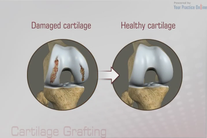 Cartilage Grafting | General Orthopaedics Videos | Your Practice Online ...