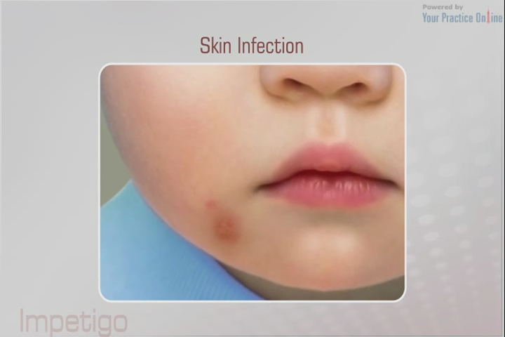 Impetigo Treatment Video | Skin Infection Treatment