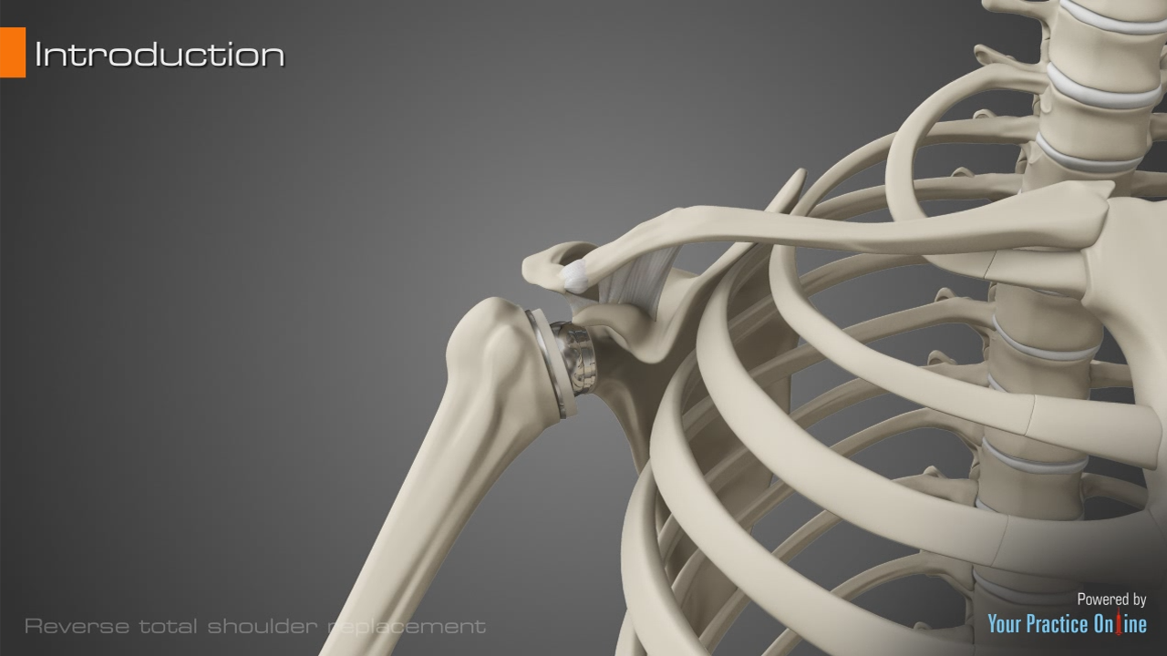 Reverse Total Shoulder Replacement Video | Medical Video Library