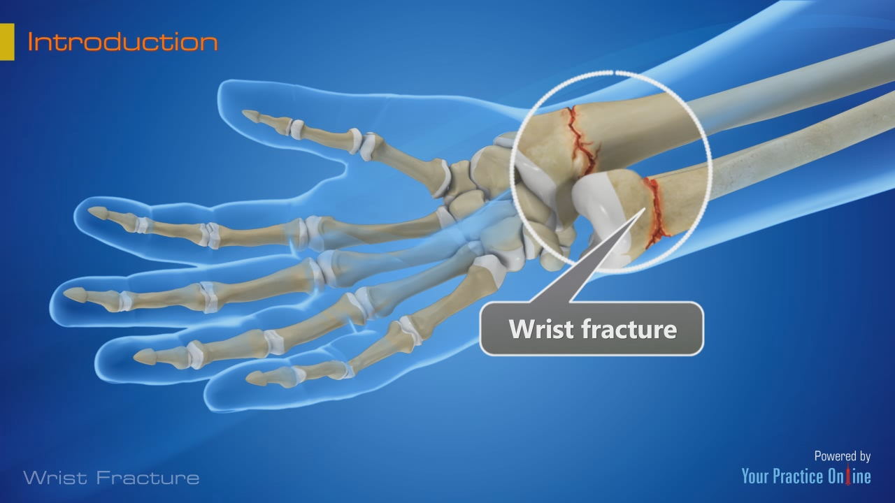 Wrist Fracture Video | Medical Video Library