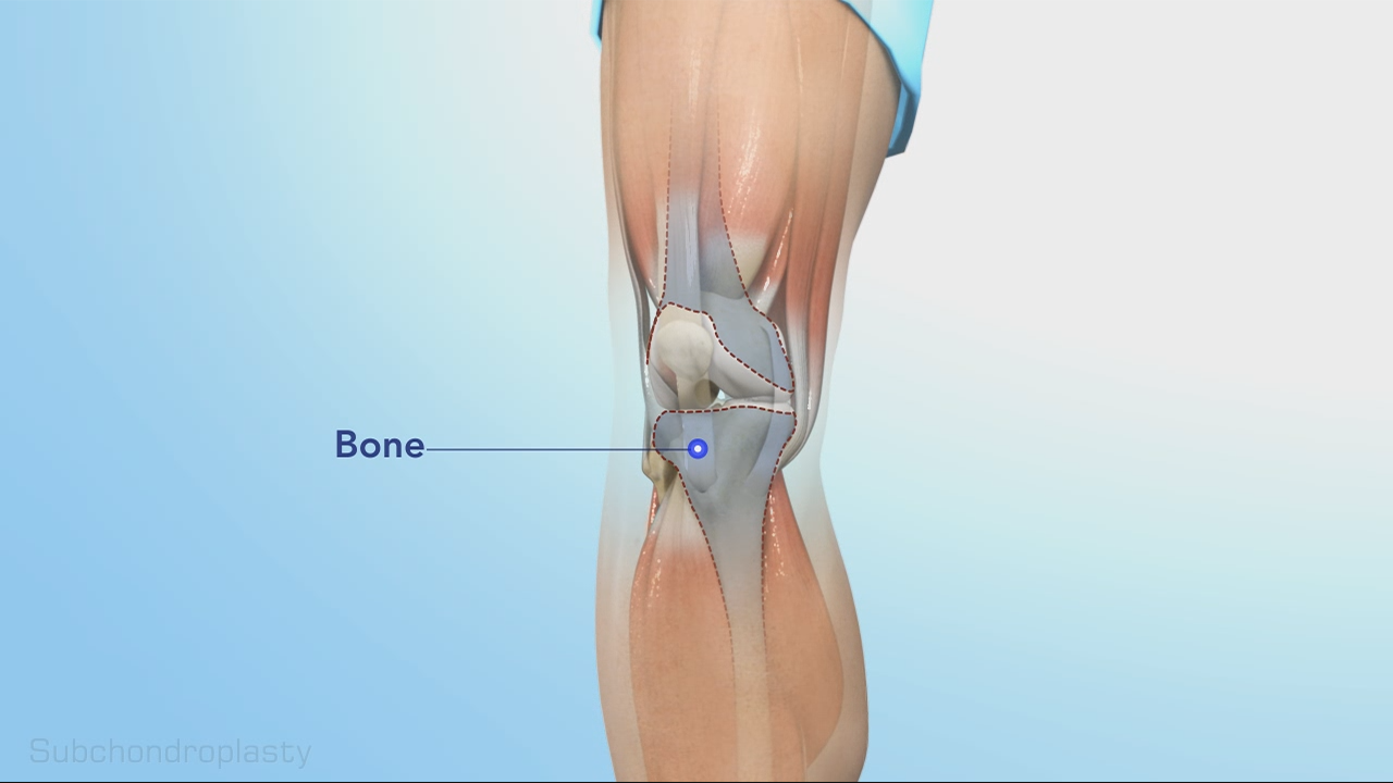 Subchondroplasty Video | Knee Orthopaedics Videos | Your Practice ...