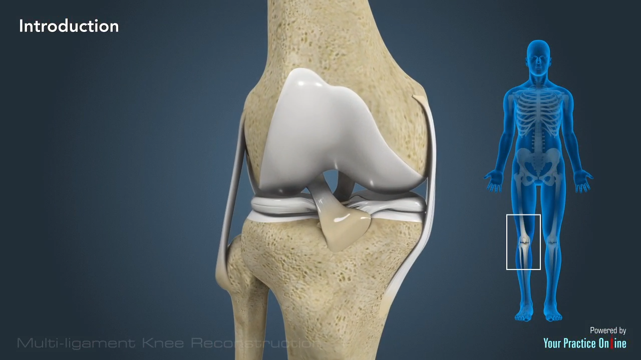 Multiligament Knee Reconstruction Video | Medical Video Library