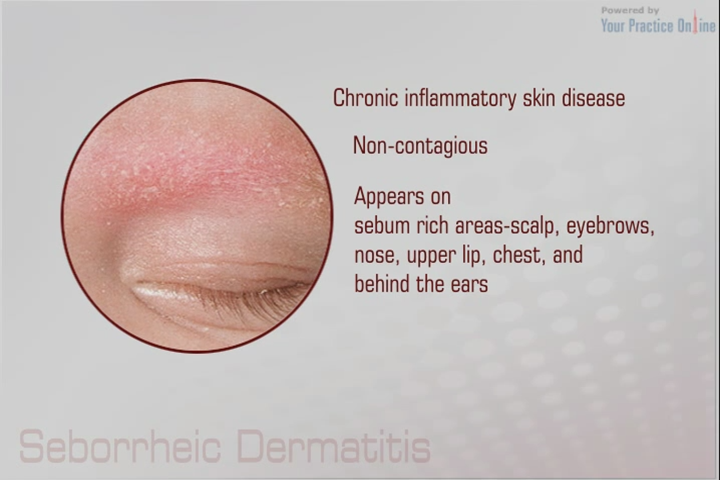 Seborrheic Dermatitis Treatment Video | Skin Disease