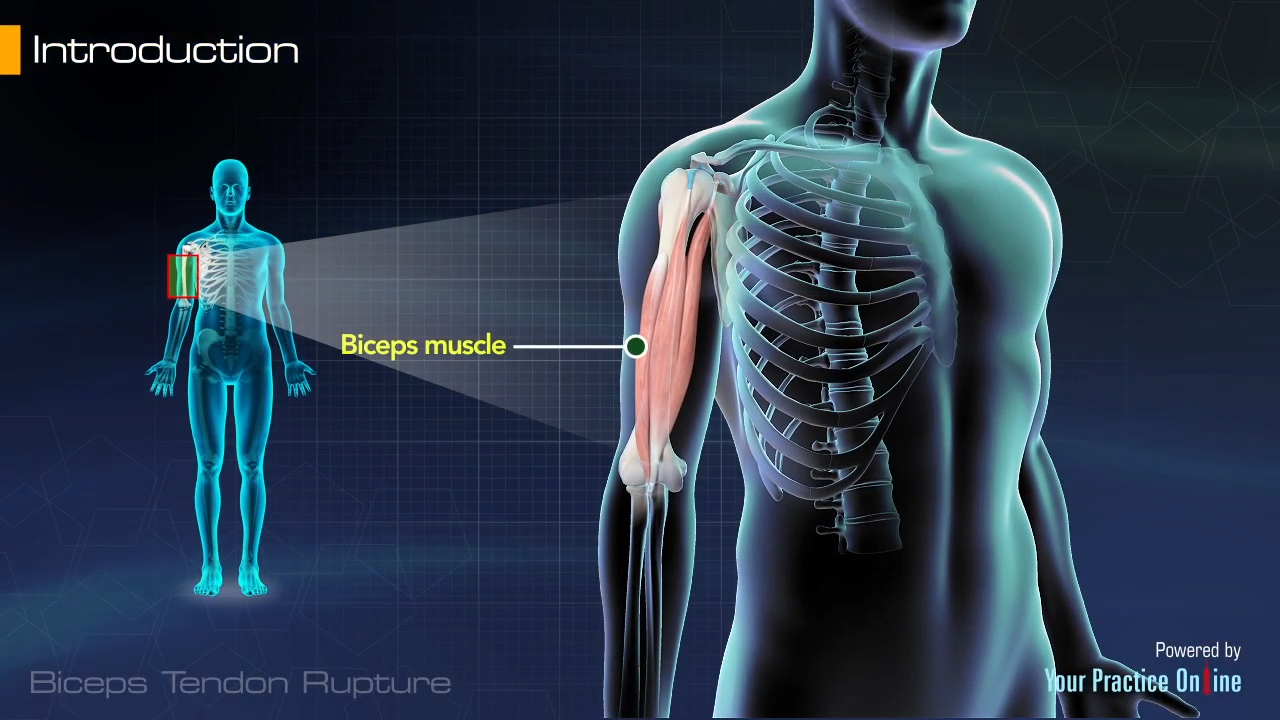 Biceps Tendon Rupture Video | Medical Video Library
