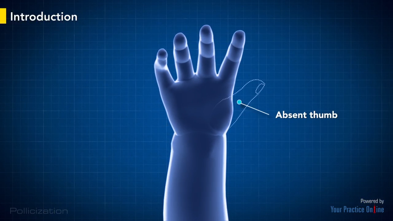 Pollicization Video | Medical Video Library