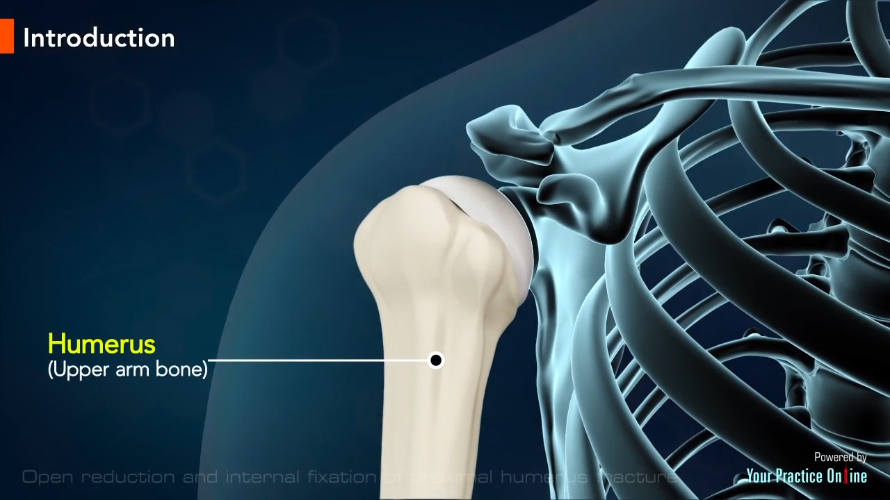 Open Reduction And Internal Fixation Of Proximal Humerus Fracture Video Medical Video Library