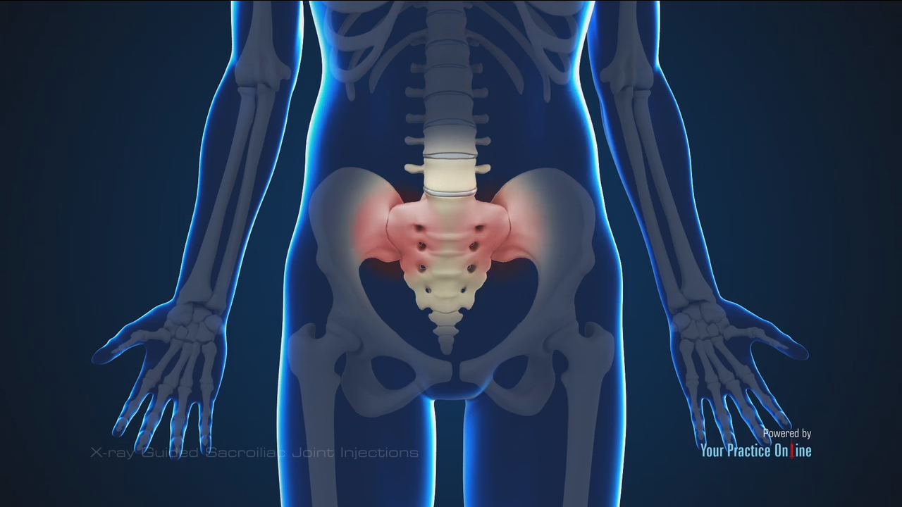 X-ray Guided Sacroiliac Joint Injections Video | Hip Orthopaedics Videos