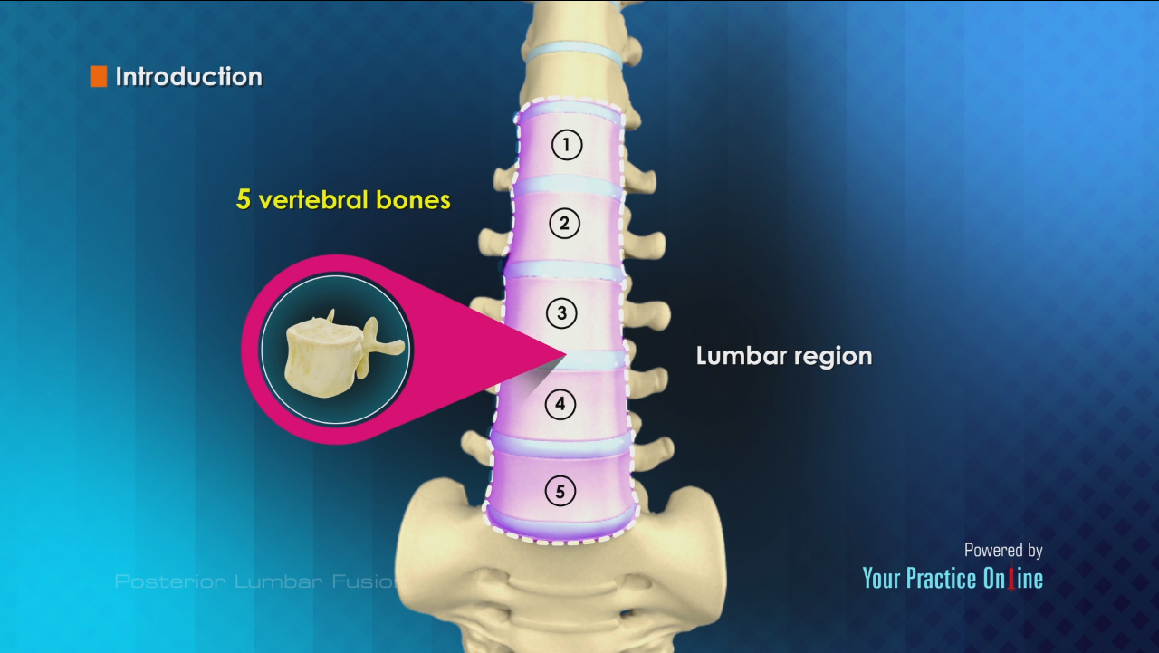 Posterior Lumbar Fusion Video | Lumbar Spinal Fusion Surgery Video