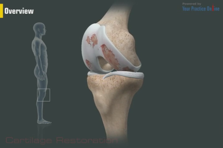 Cartilage Restoration Surgery Video | Cartilage Tear Treatment Video