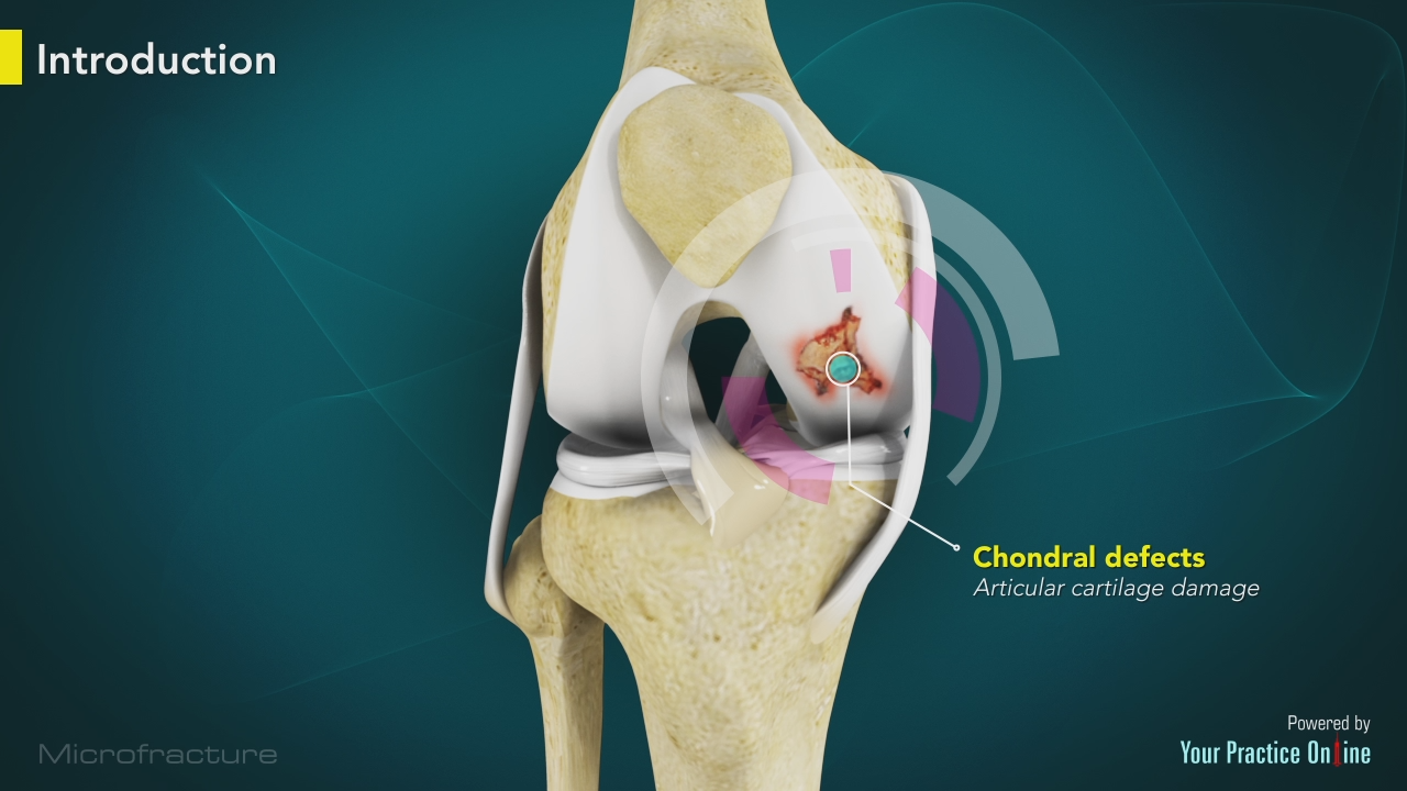 Microfracture Surgery Video | Articular Cartilage Damage Repair Video
