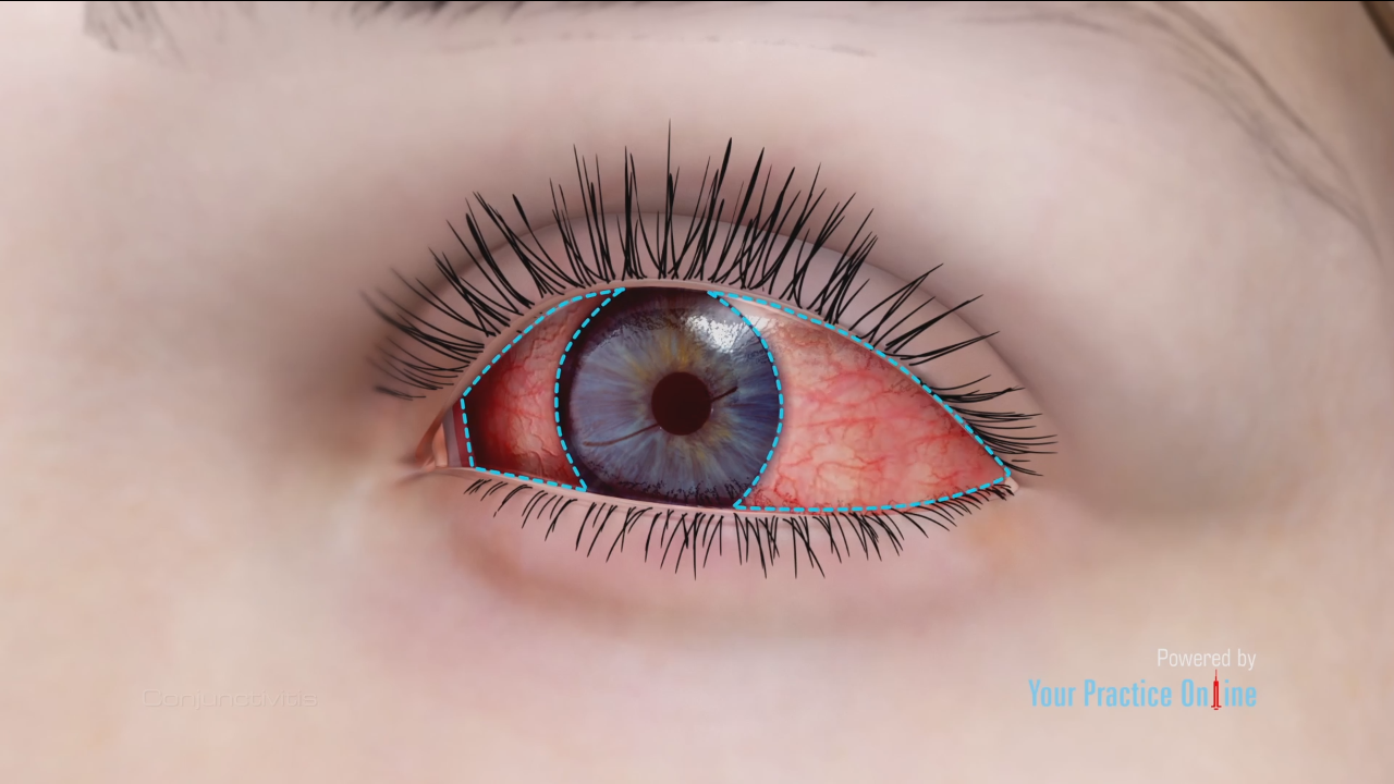 Conjunctivitis Video | Medical Video Library