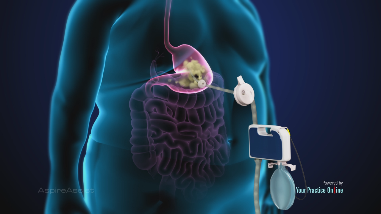 The AspireAssist Video | Medical Video Library