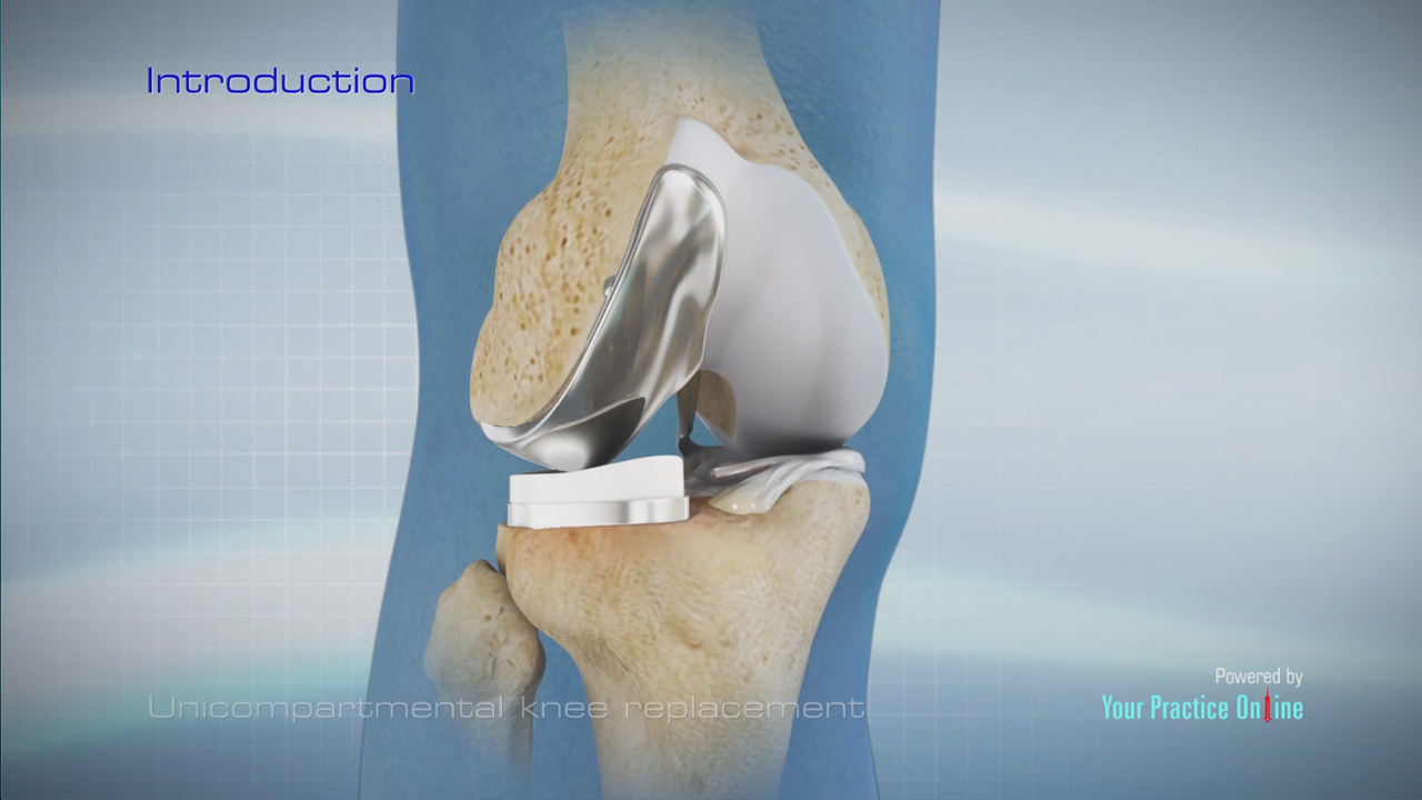 Uni Knee Replacement Video | Medical Video Library