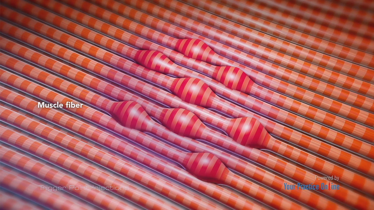 Trigger Point Injections Video | Medical Video Library