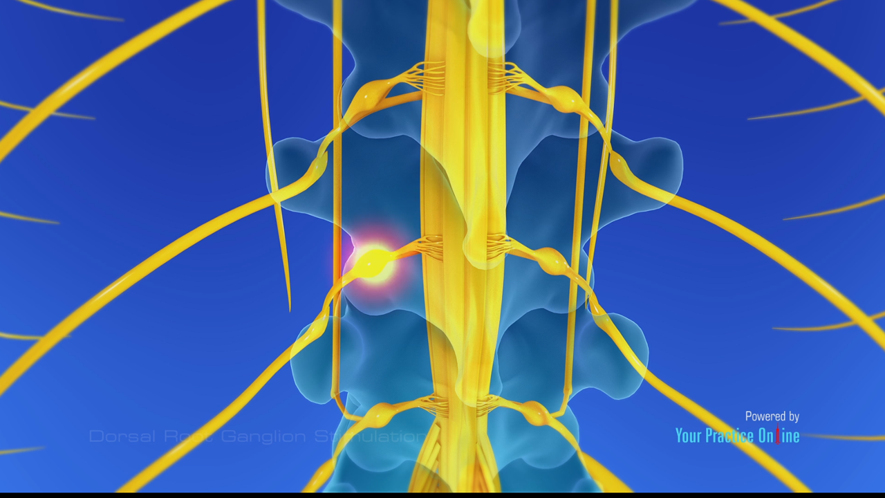 Dorsal Root Ganglion Stimulation Video | Medical Video Library