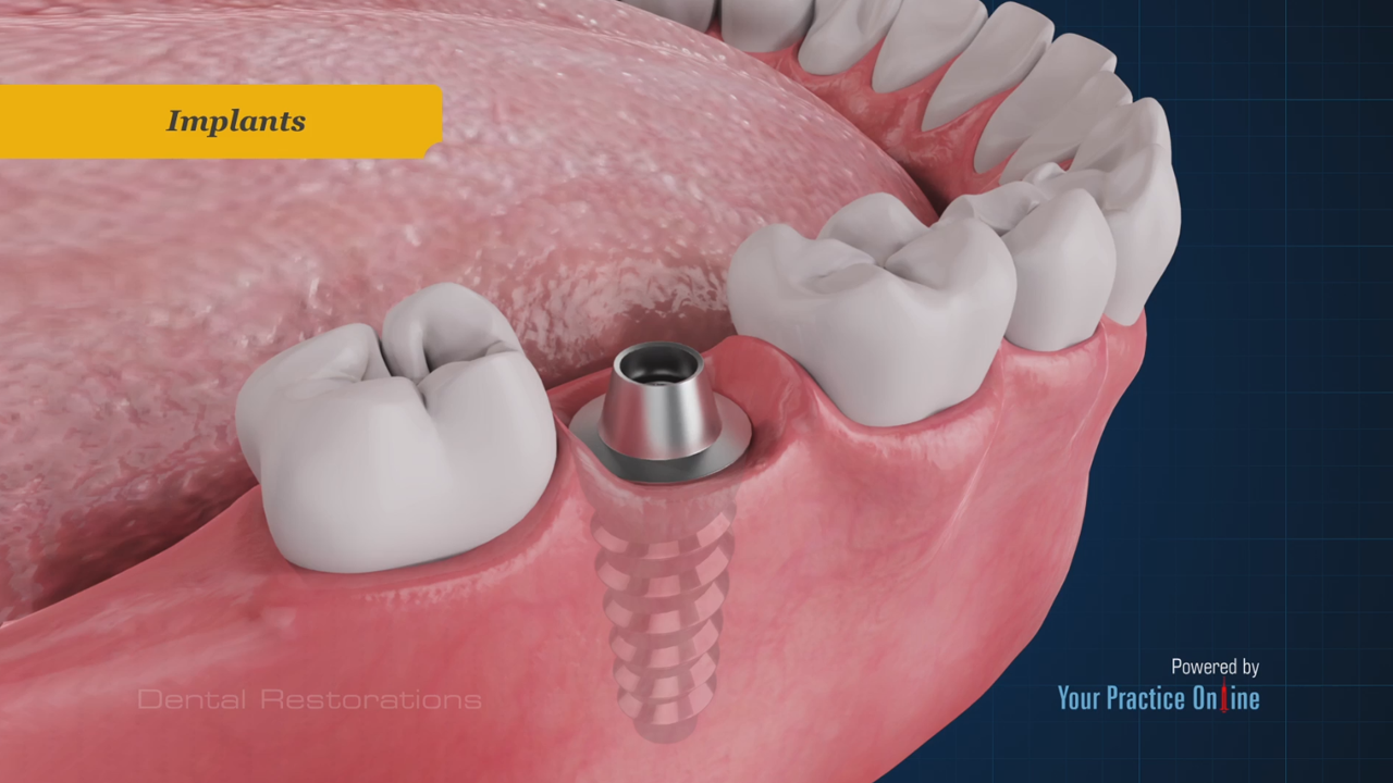 Dental Restorations Video | Medical Video Library