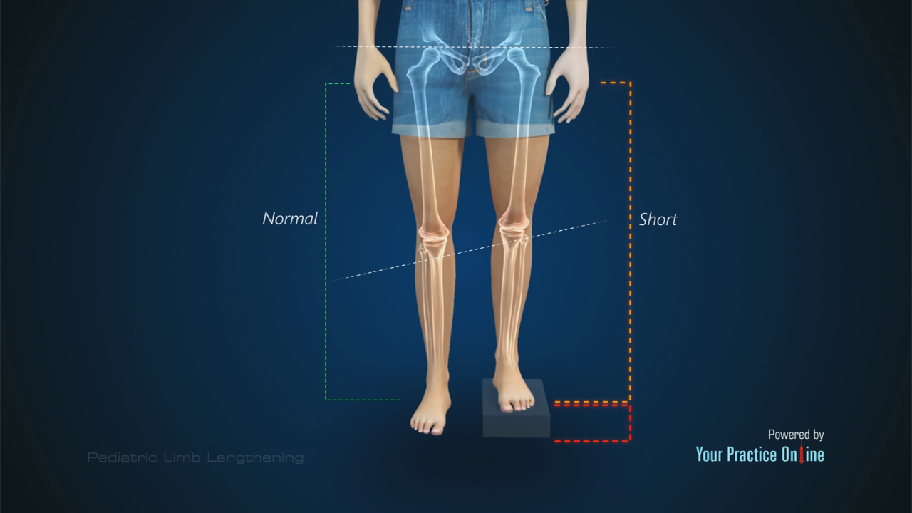 Pediatric Limb Lengthening Video | Medical Video Library