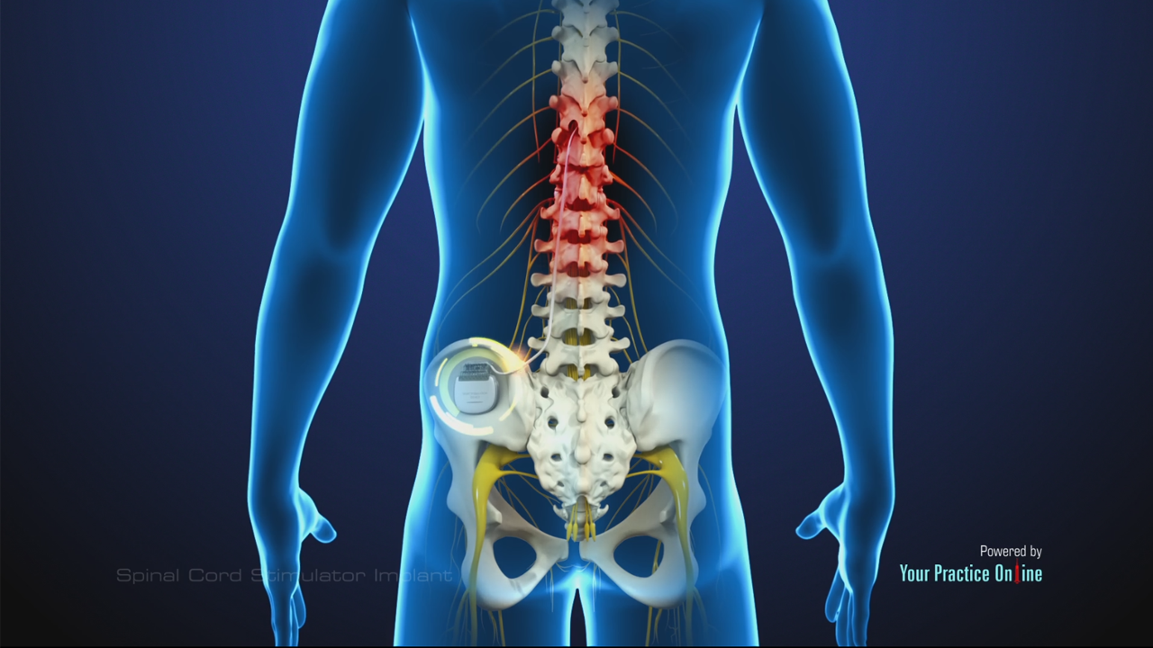 Spinal Cord Stimulator Implant Video | Medical Video Library