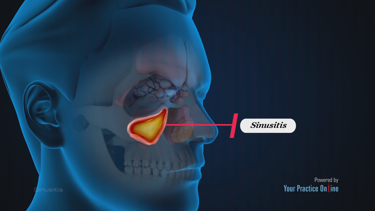 Sinusitis Video | Medical Video Library