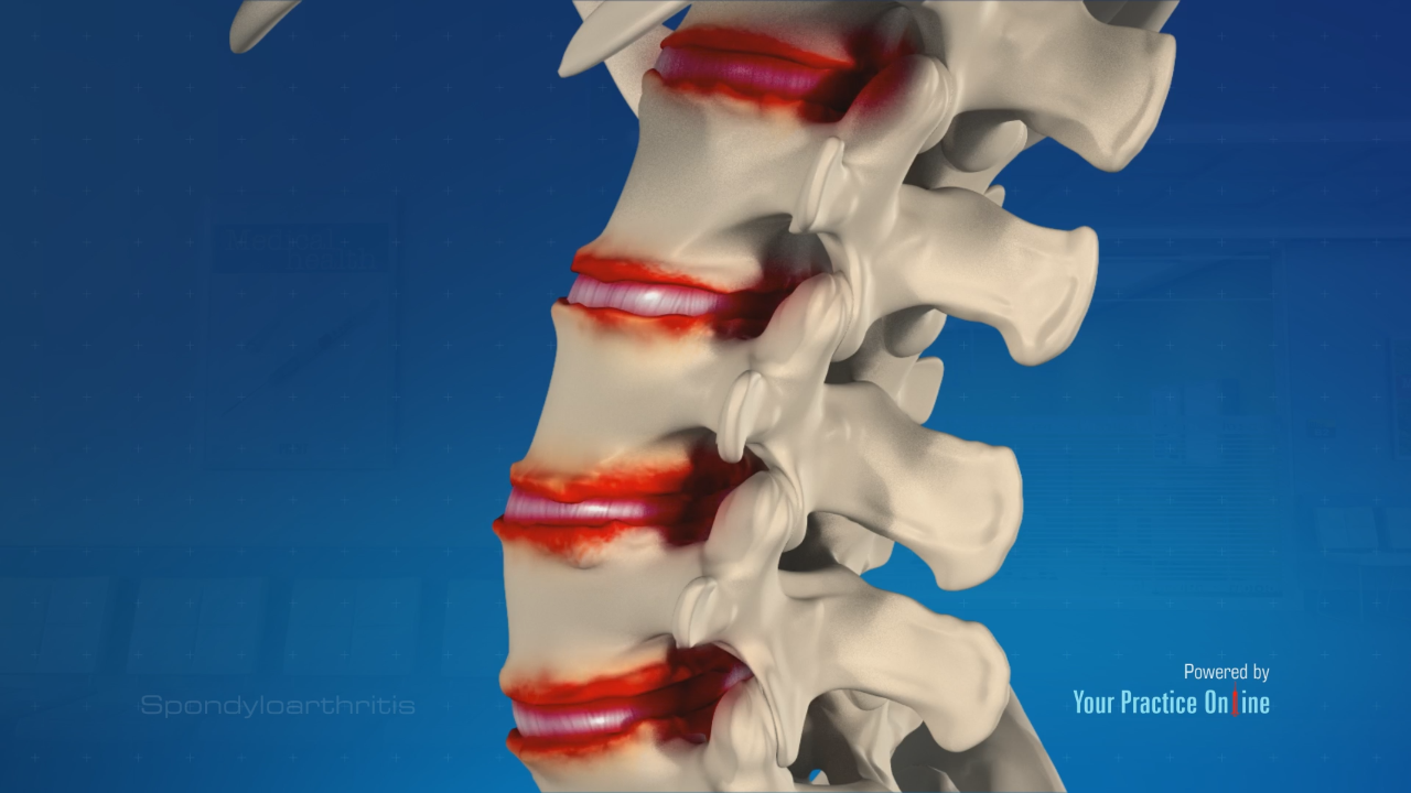Spondyloarthritis Video | Medical Video Library