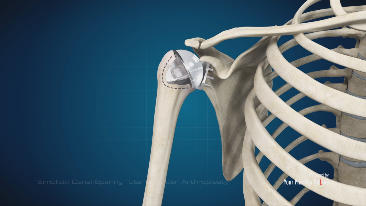 Simpliciti Canal-Sparing Total Shoulder Arthroplasty Video | Medical ...
