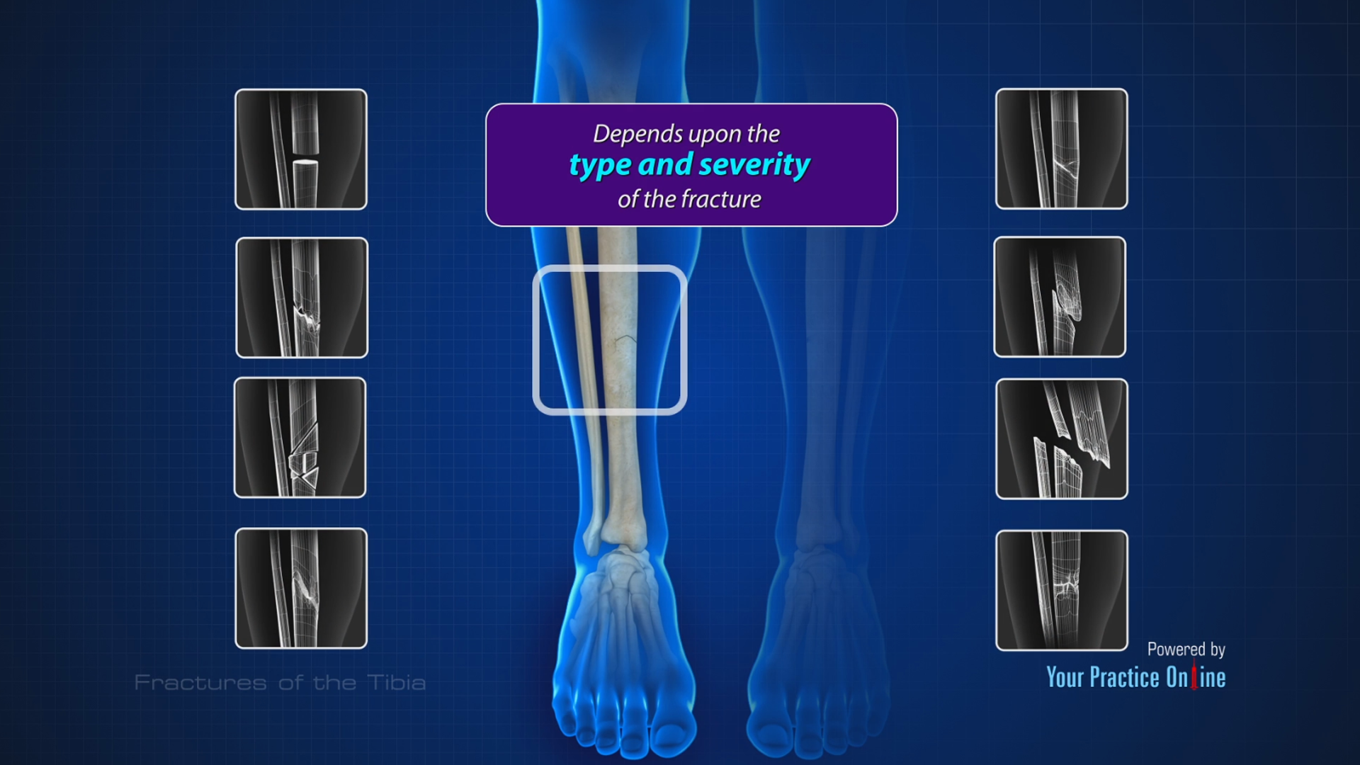 Fractures of the Tibia Video | Medical Video Library