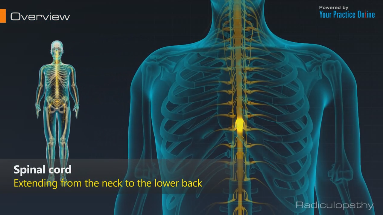 Spinal Radiculopathy Video | What is Sciatica? | Spine Pain Treatment Video