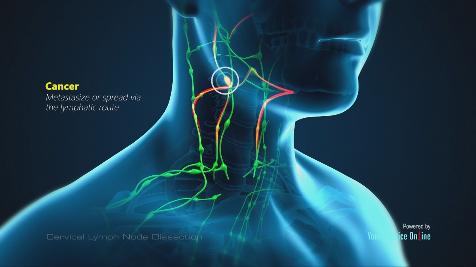 Lymph Node Dissection Lymphadenectomy Procedure QBUH