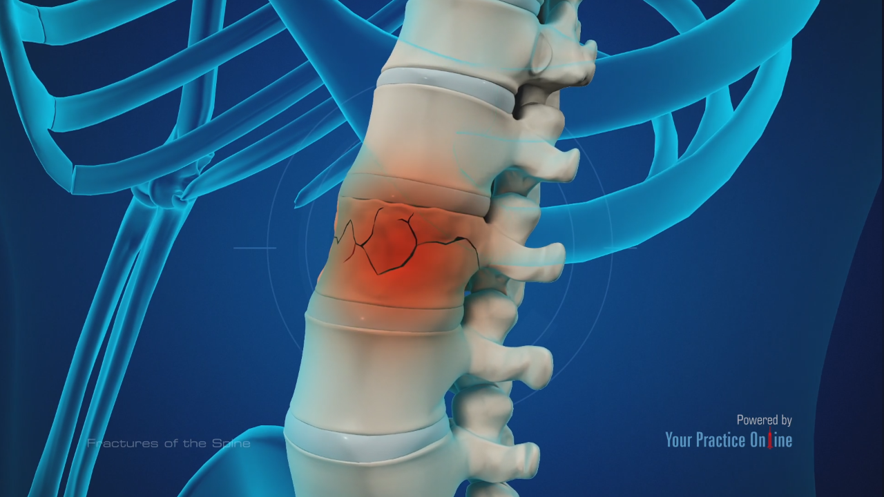 Fractures of the Spine Video | Medical Video Library