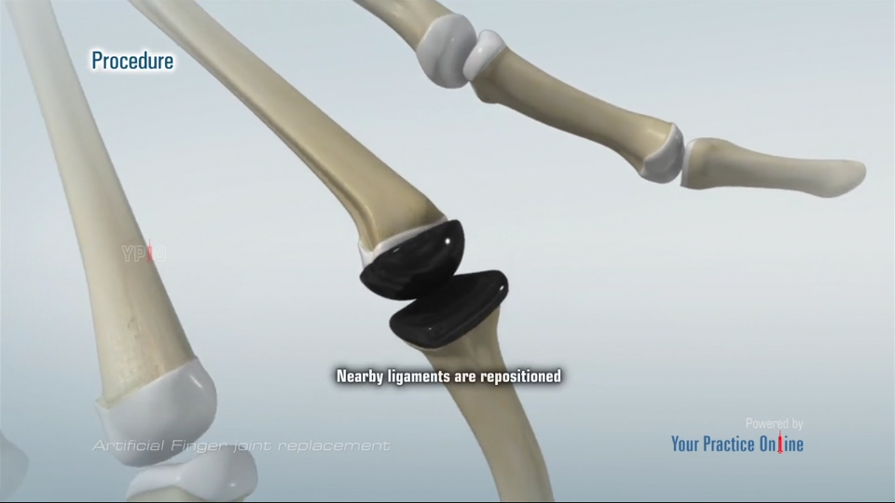 Artificial Finger Joint Replacement Video | Medical Video Library
