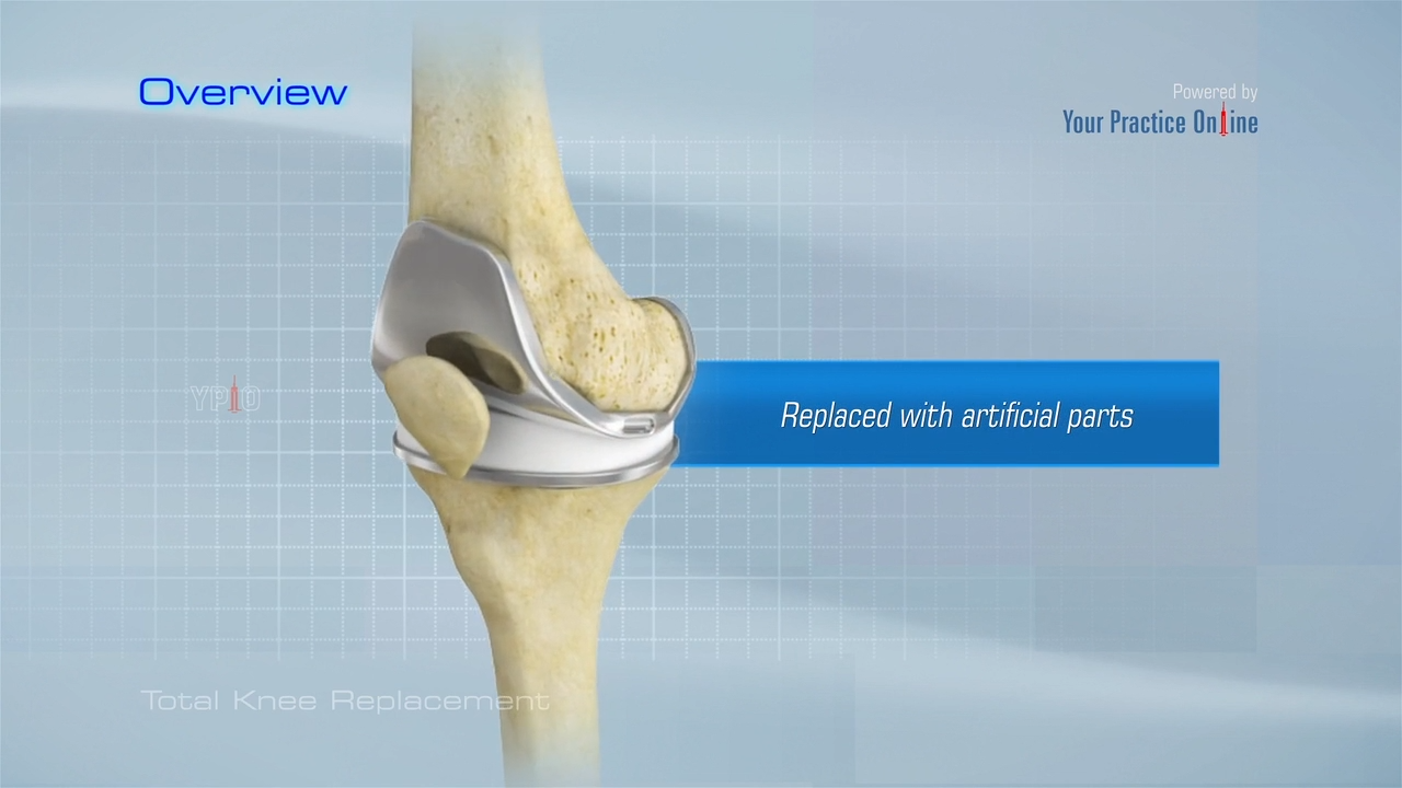 Total Knee Replacement Video | Medical Video Library