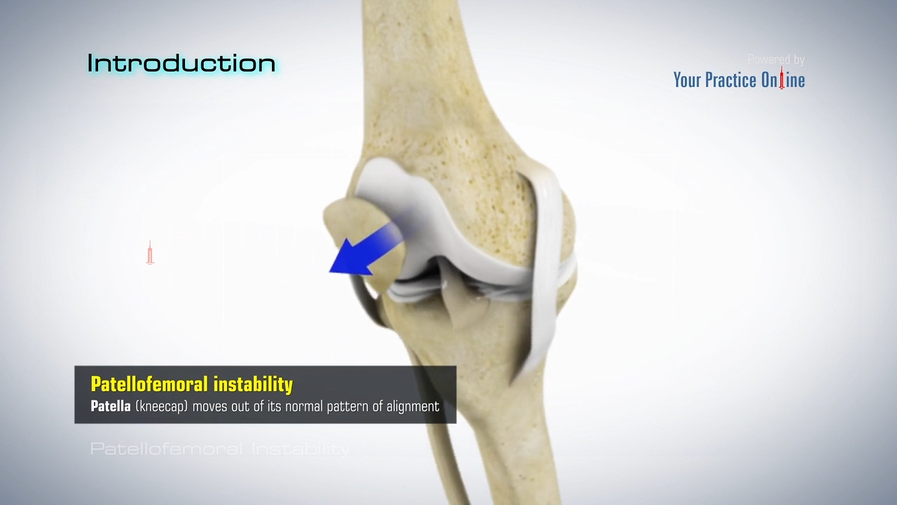 Patellofemoral Instability Video | Medical Video Library