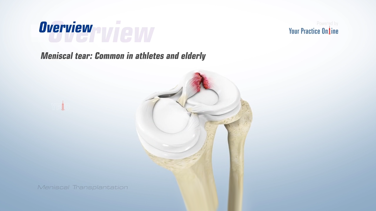 Meniscal Transplantation Video | Medical Video Library