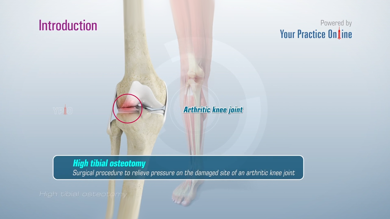 High Tibial Osteotomy Video | Medical Video Library