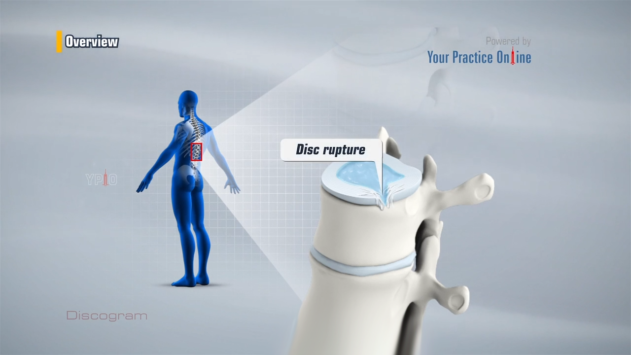 Discogram Video | Spinal Condition Diagnosis | Spinal Injury Diagnosis