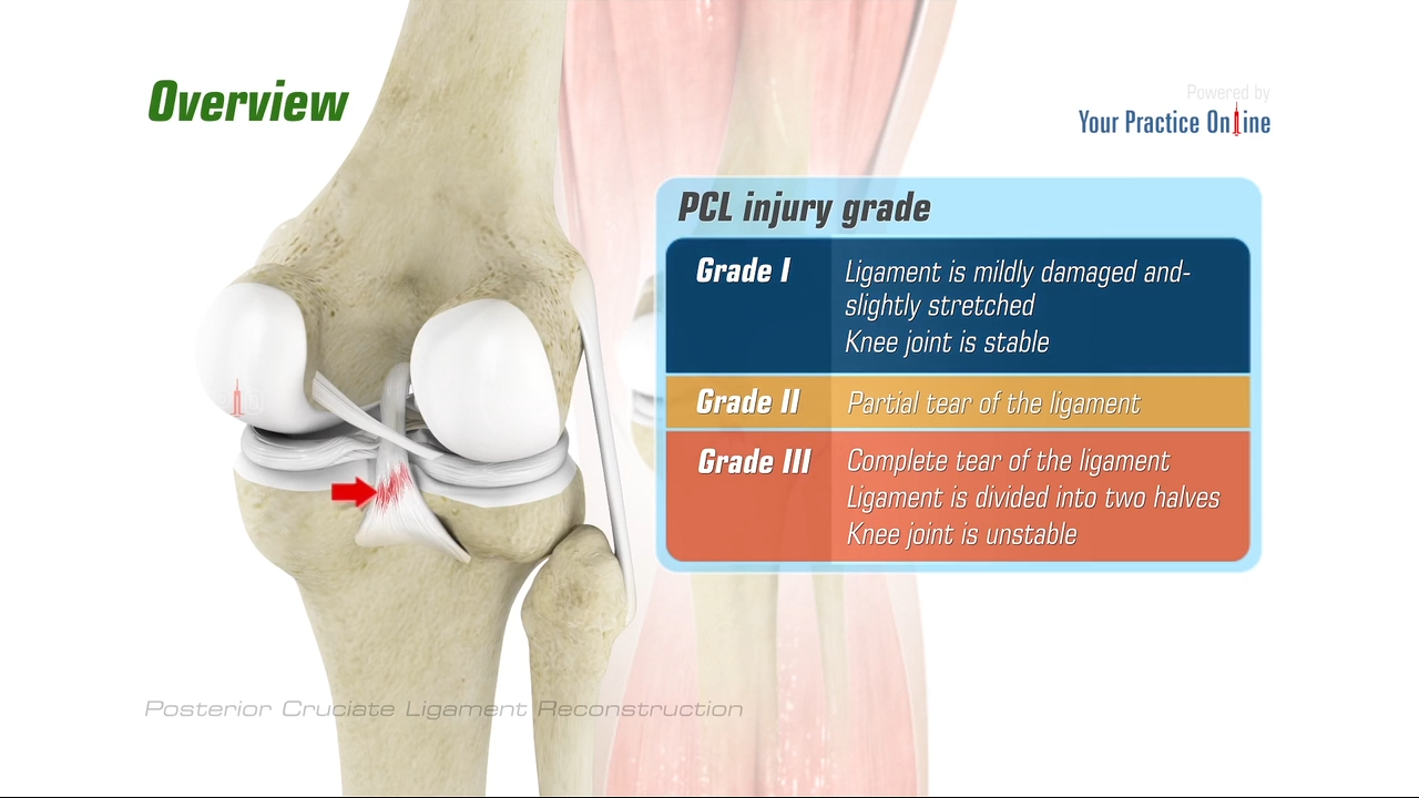 Posterior Cruciate Ligament Reconstruction Video | Medical Video Library
