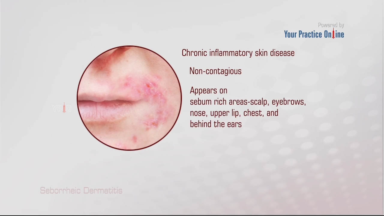 Seborrheic Dermatitis Treatment Video | Skin Disease