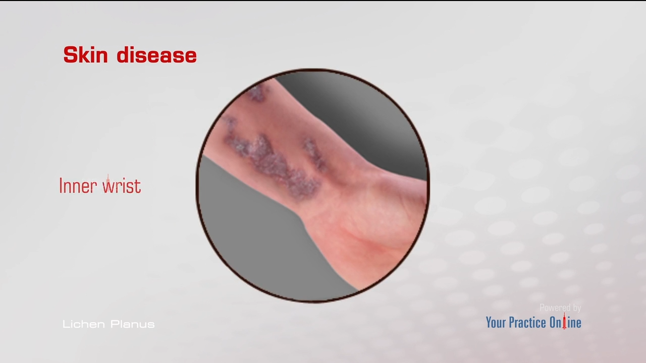 Lichen Planus Treatment Video | Skin Disease Treatment