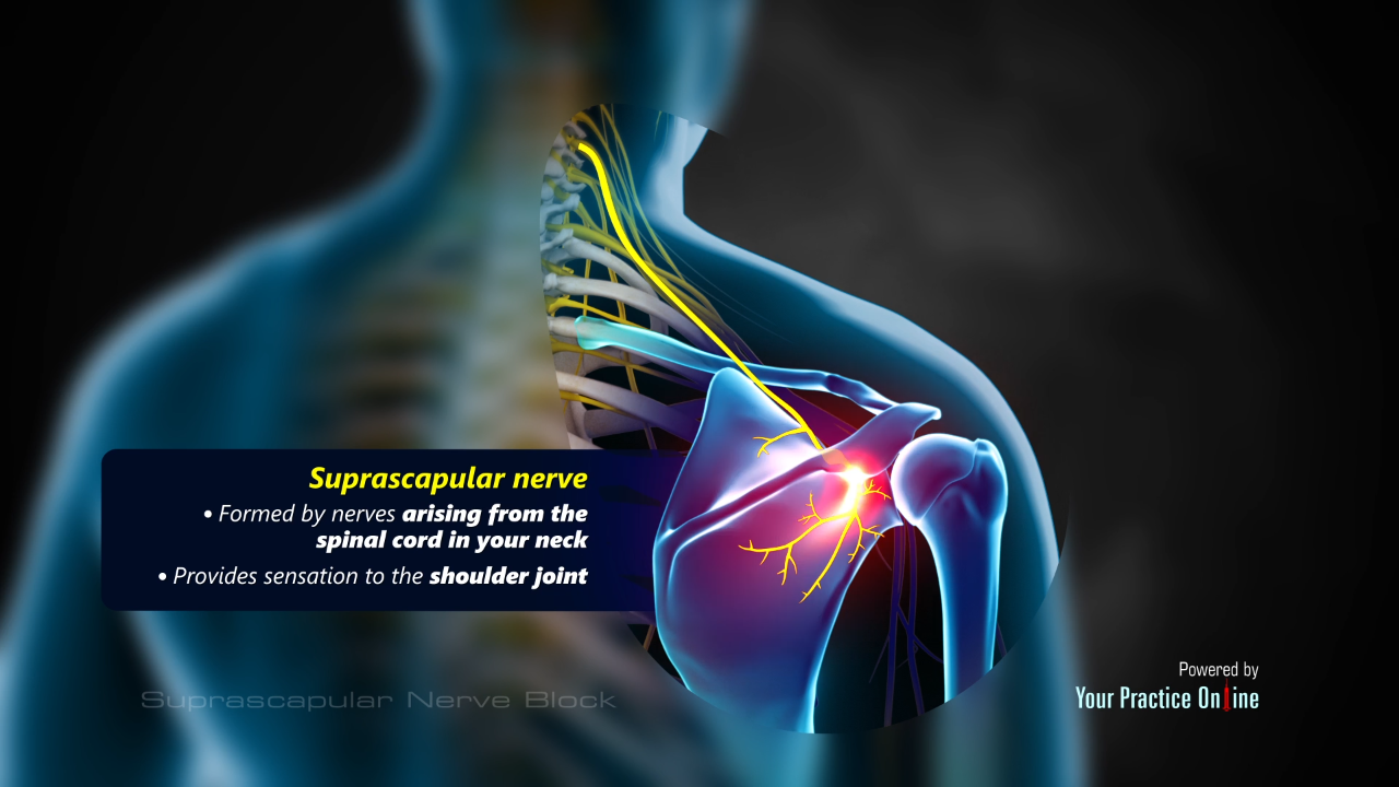 Suprascapular Nerve Entrapment Syndrome