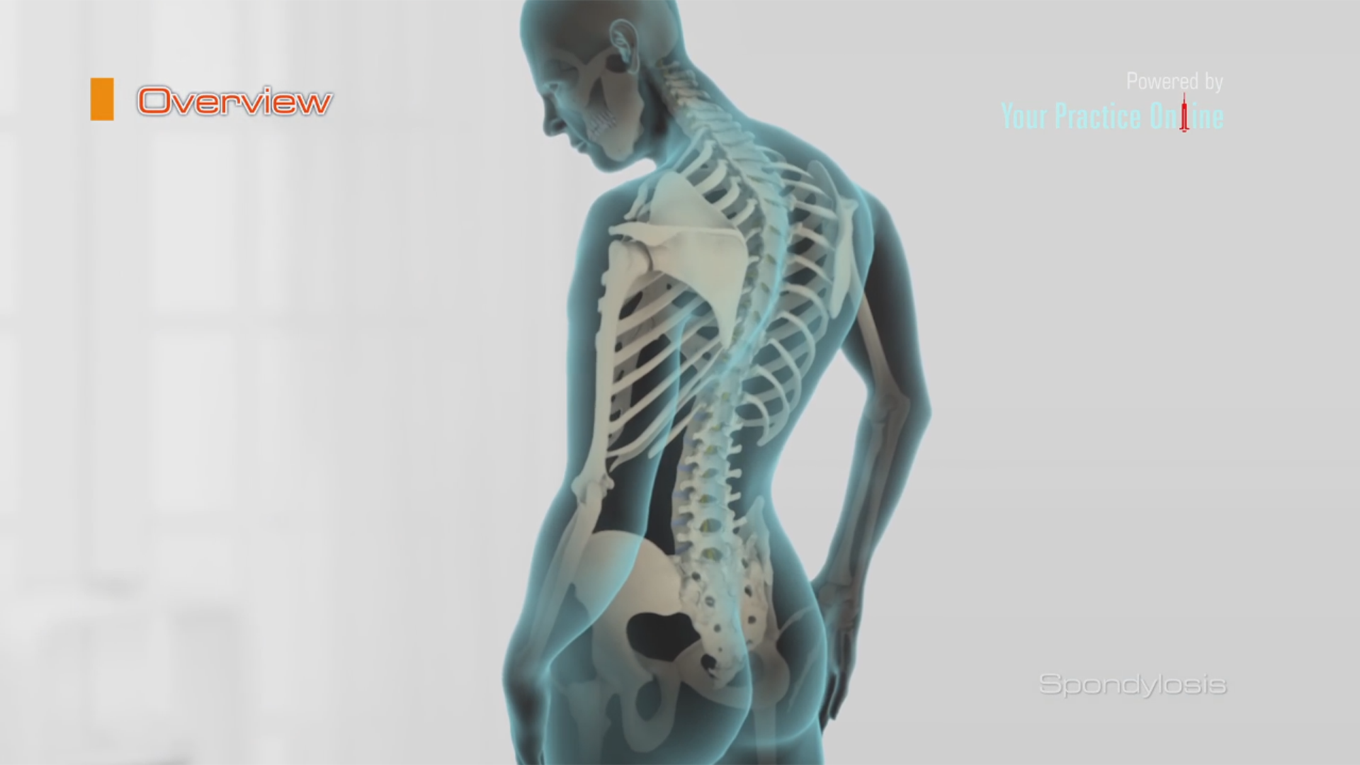 What is Spondylosis? | Spondylosis Treatment Procedure Video ...