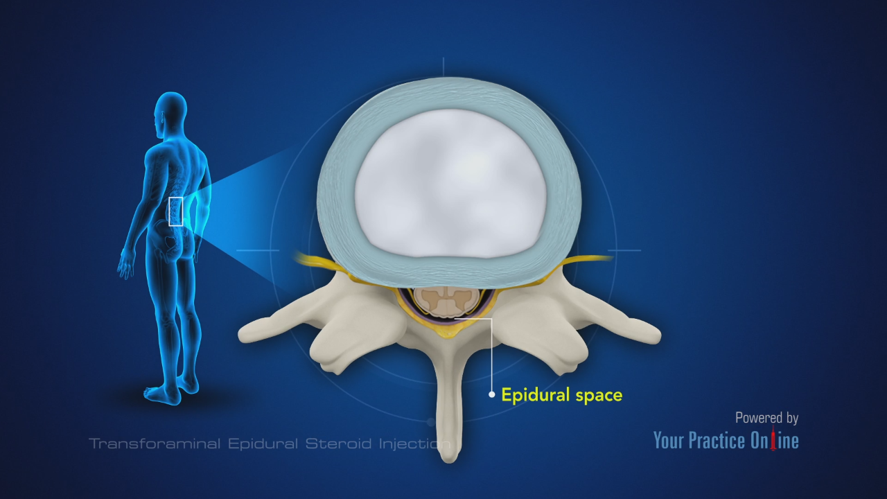 Transforaminal Epidural Steroid Injection Video | Medical Video Library