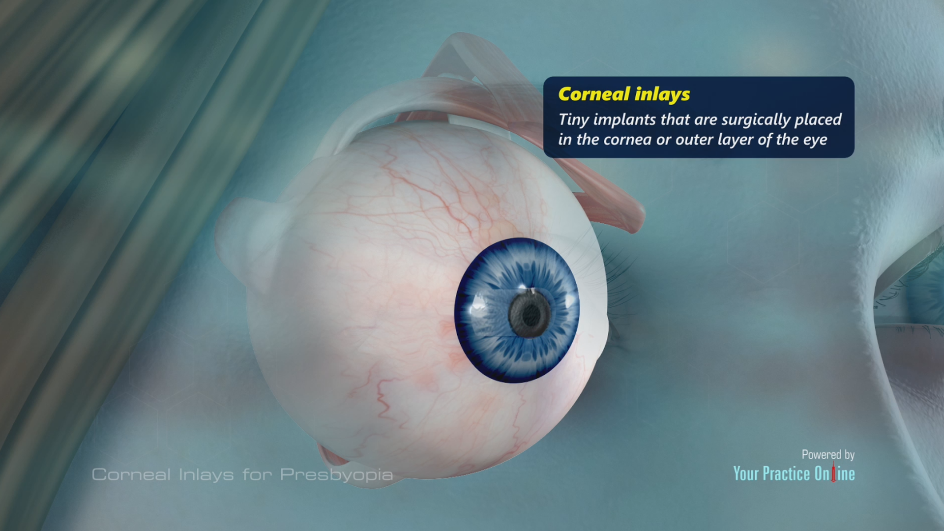 Corneal Inlays for Presbyopia Video | Medical Video Library