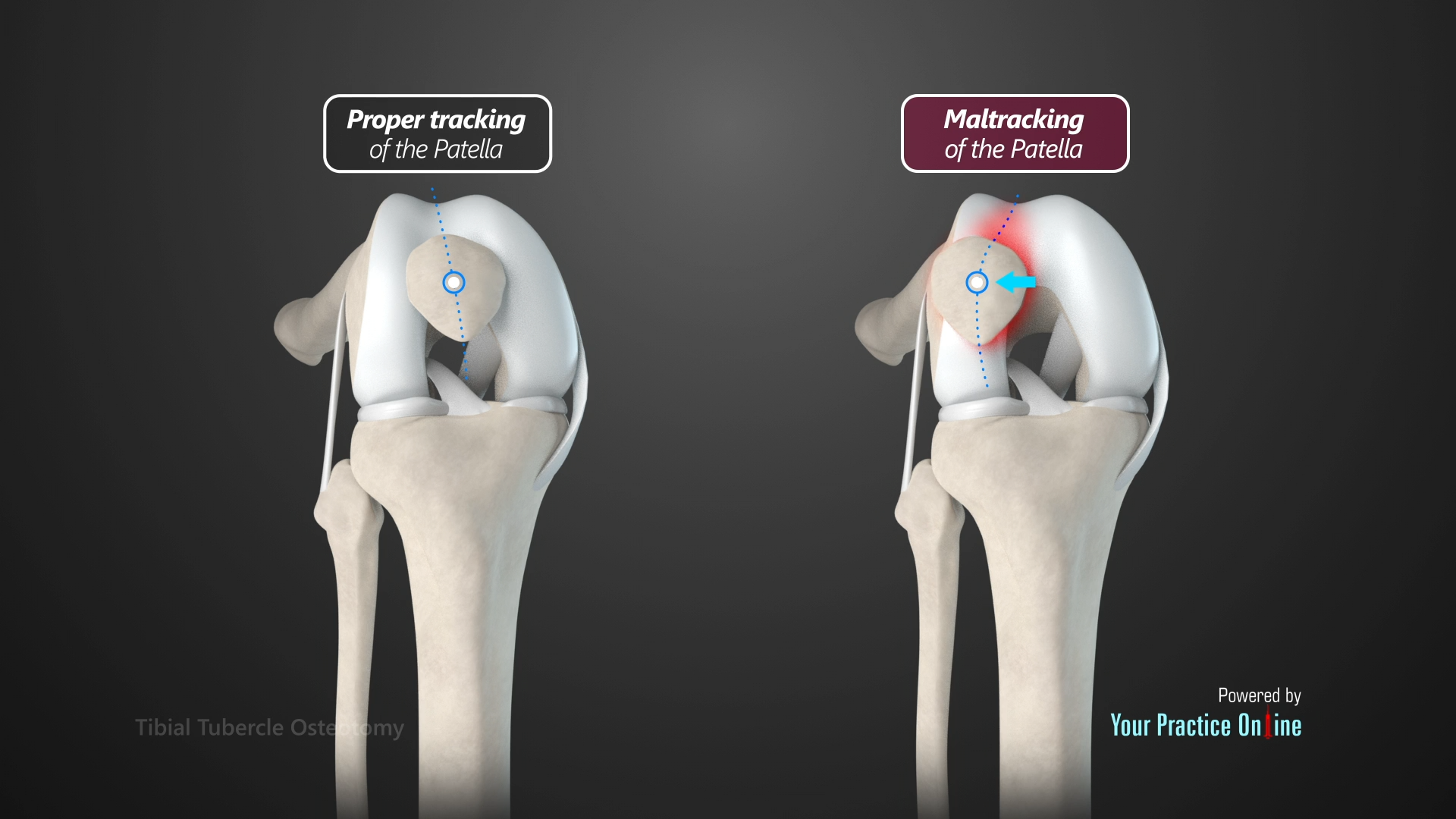 Tibial Tubercle Osteotomy Video Medical Video Library