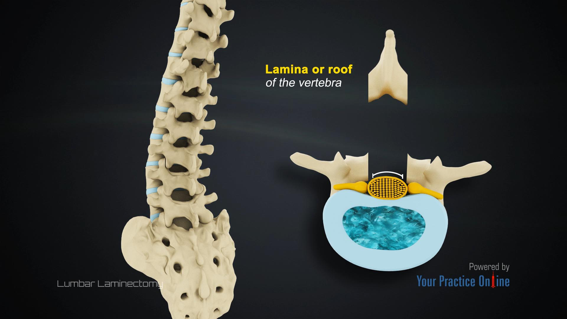 Lumbar Laminectomy Video | Medical Video Library