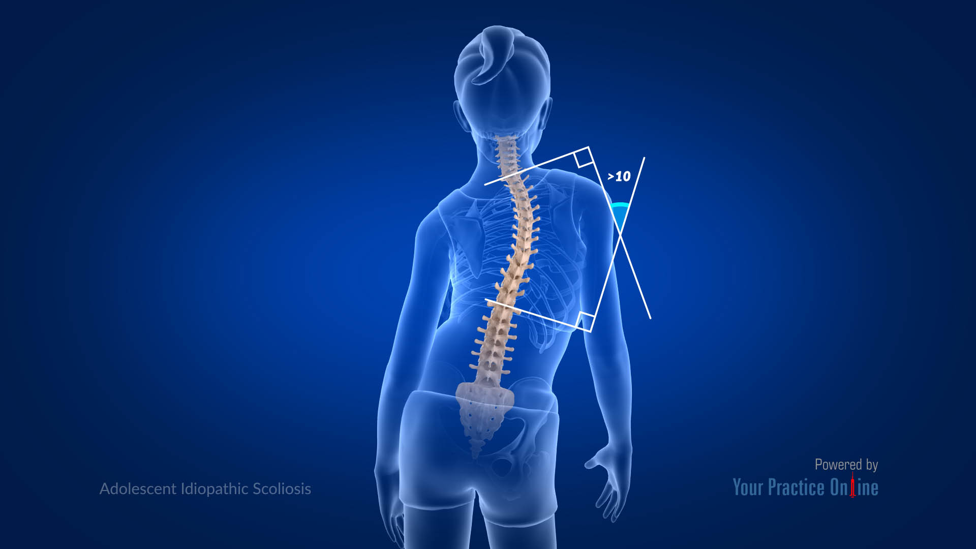 Adolescent Idiopathic Scoliosis (Including bracing for and surgery ...