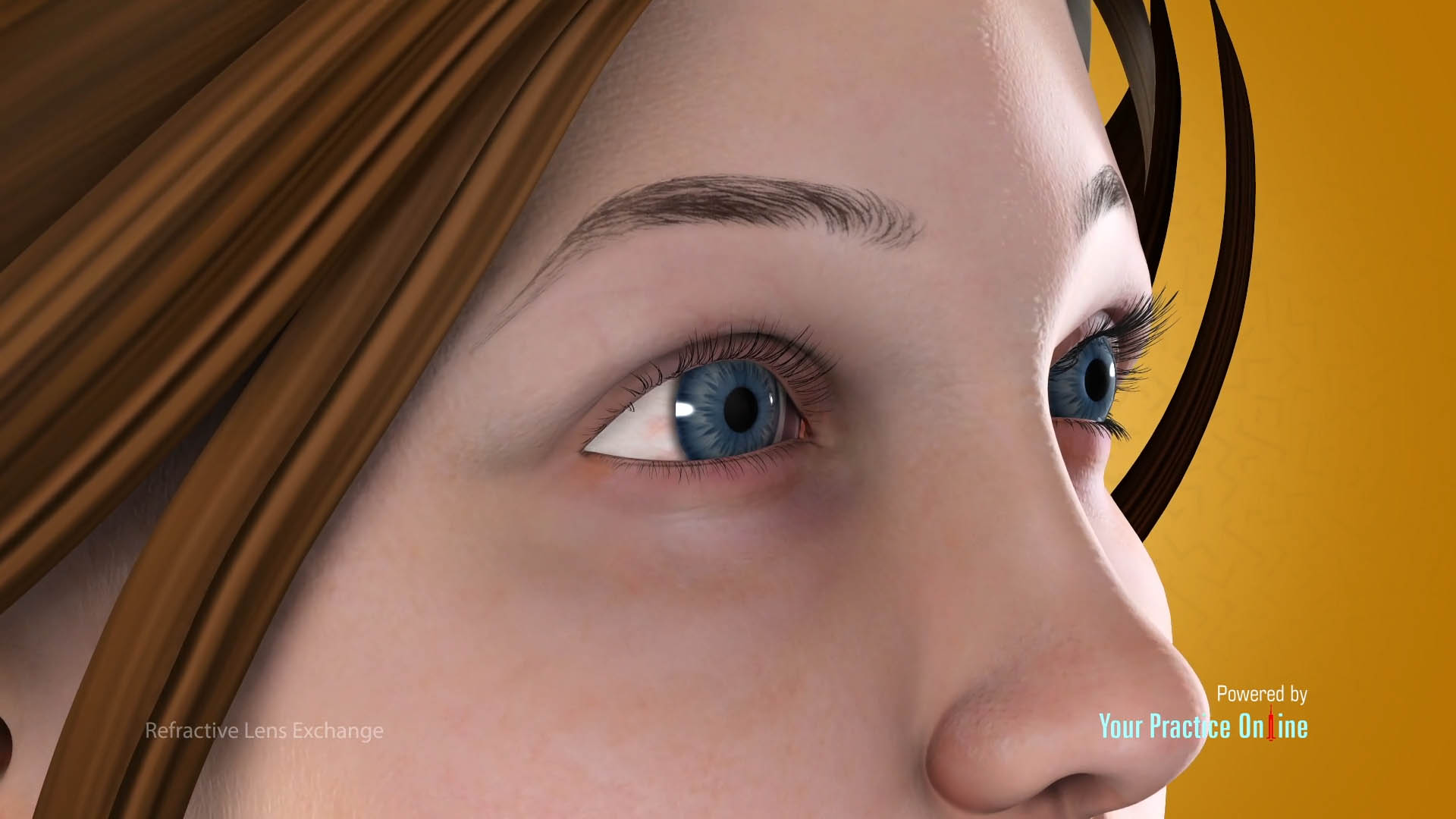 Refractive Lens Exchange Video | Medical Video Library